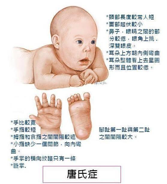 唐氏综合征 染色体异常导致的疾病 搜狗百科