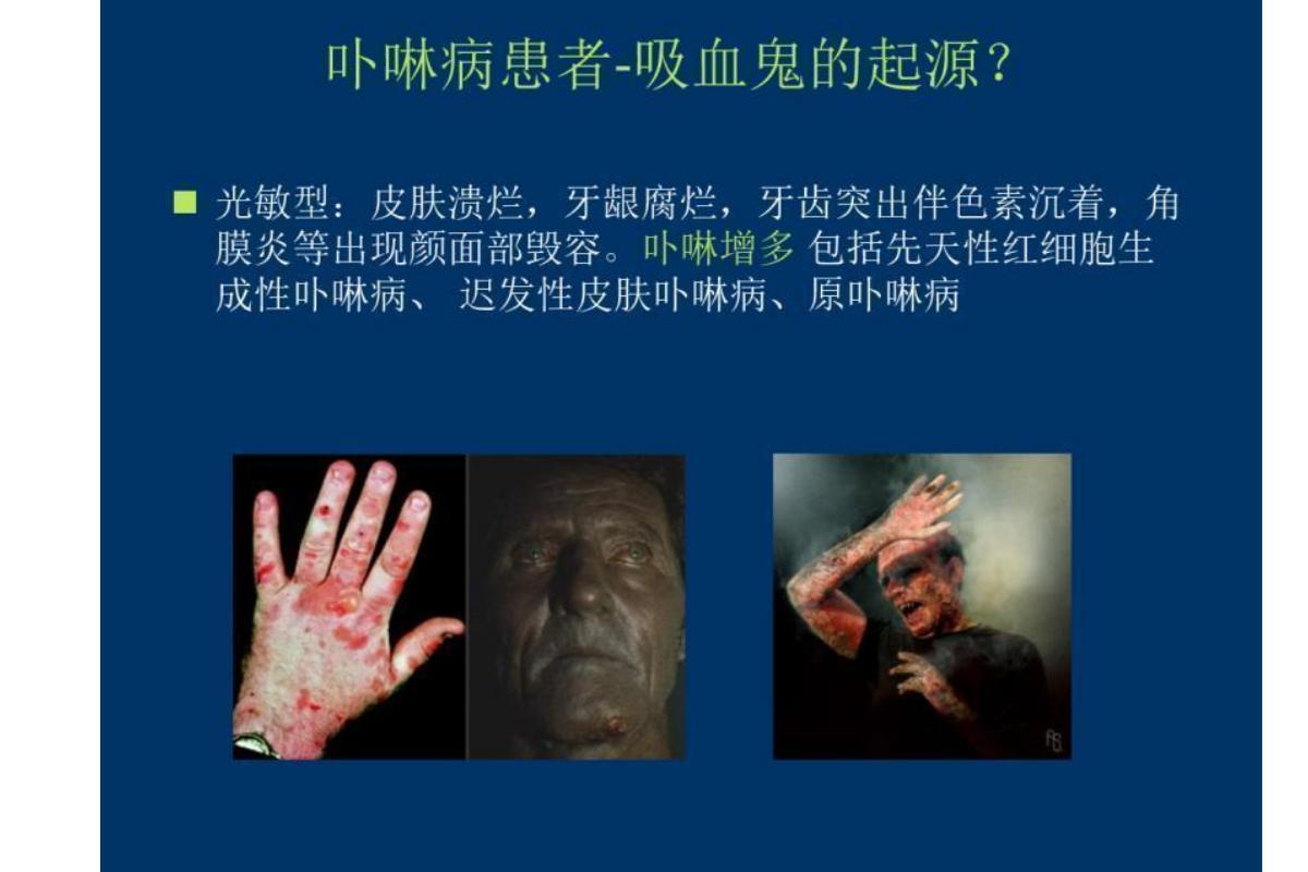 卟啉病 由于血红素生物合成途径中的酶缺乏引起的一组疾病 搜狗百科