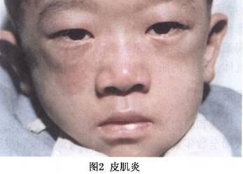 皮肌炎Gottron征 - 搜狗百科