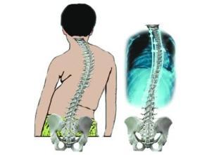 脊柱畸形 - 搜狗百科