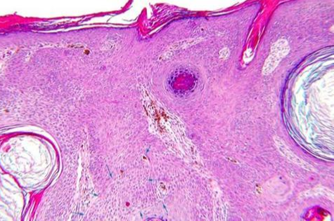 毛盘瘤 - 搜狗百科