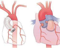 Ross-Konno手术 - 搜狗百科