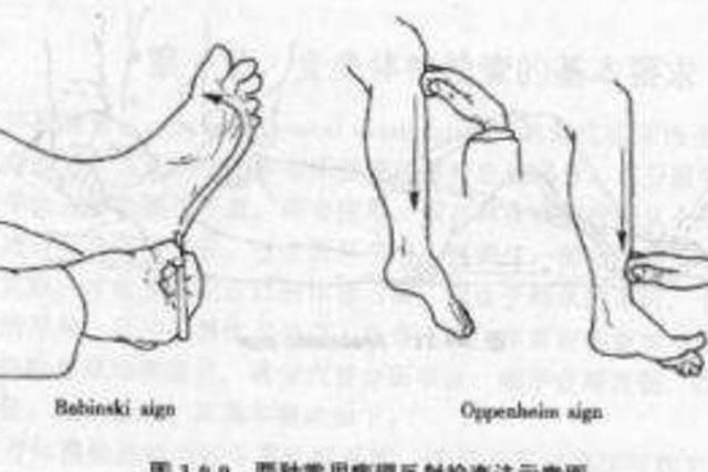 病理反射(中枢神经系统受损时发生的异常反射)_搜狗百科